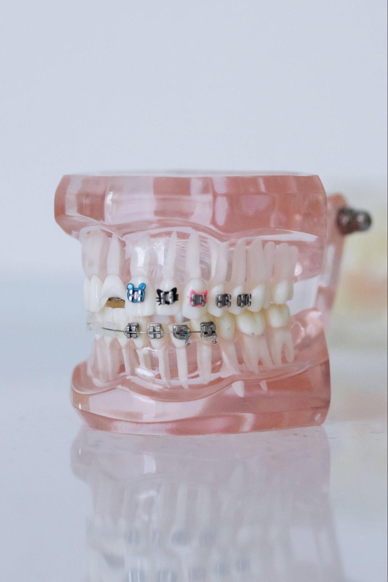 Smile 360 On Choosing the right Teeth Braces: Types and Benefits ...